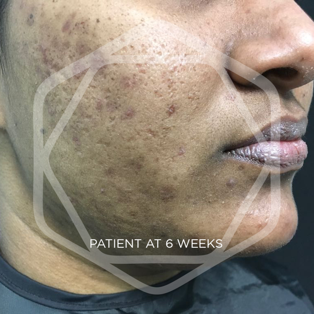 Can toothpaste get rid of acne? - CellDerma USA