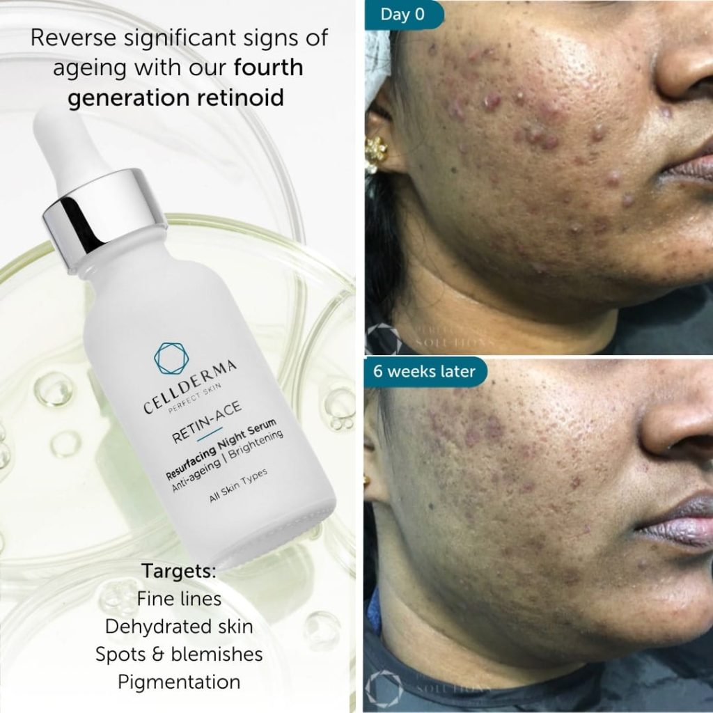 Retin-ACE® - CellDerma USA