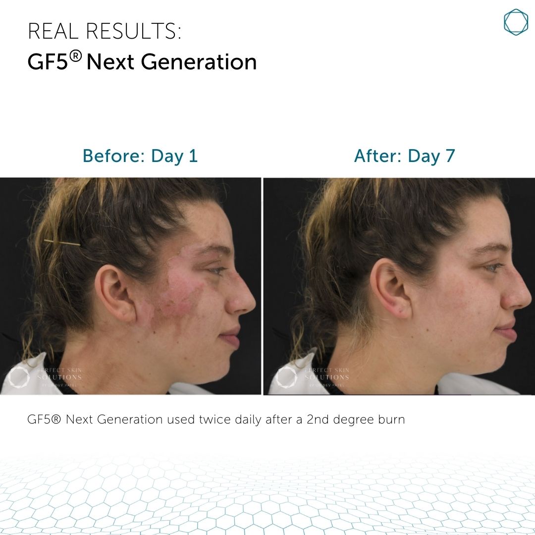 GF5 Bio-Regenerative Growth Factor Serum - CellDerma | Perfect Skin